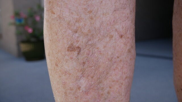 Medical Laser Applications In Podiatry - K-Laser Resources